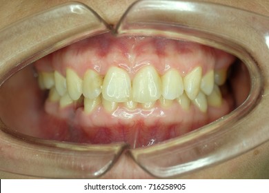 Loss First Bicuspid Teeth Stock Photo 723681970 | Shutterstock