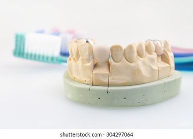 Dental Cast During Processing Denture Stock Photo 304297064 | Shutterstock
