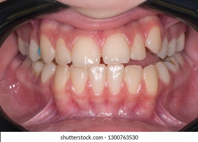2,508 Dental open bite Images, Stock Photos & Vectors | Shutterstock