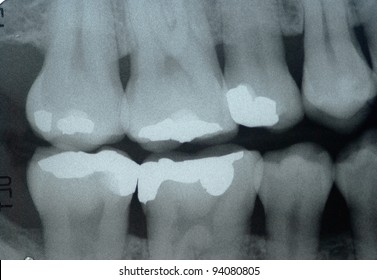 1,373 Tooth decay ray Images, Stock Photos & Vectors | Shutterstock