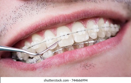 Dentist Checking Teeth Ceramic Brackets Using Stock Photo 744666994 ...