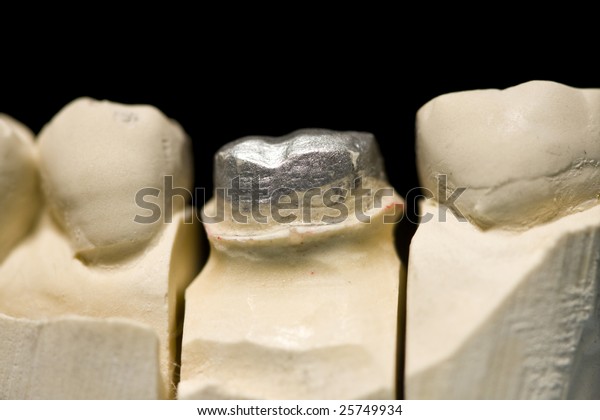 Dentistry Molar Crown Tooth Prep Side Stock Photo (Edit Now) 25749934