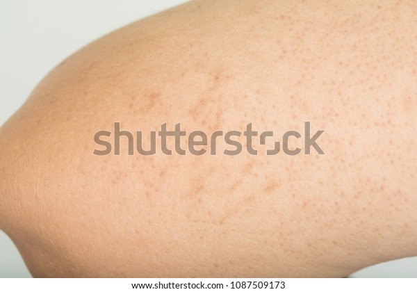 Dermatitis Abnormal Upper Arm Stock Photo 1087509173 | Shutterstock
