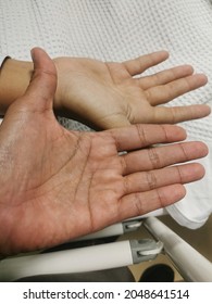 Ischemic Digital Toes Patient Peripheral Vascular Stock Photo (Edit Now ...