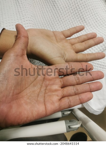 Differences Between Hands Normal Patient Anaemia Stock Photo 2048641514 ...