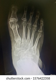 Diffuse Osteopenia No Fracture Dislocation Film Foto stock 1576422358 ...