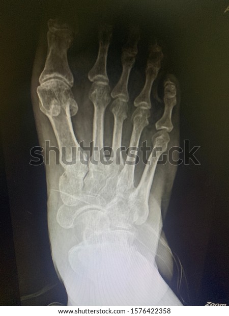 Diffuse Osteopenia No Fracture Dislocation Film Foto stock 1576422358 ...