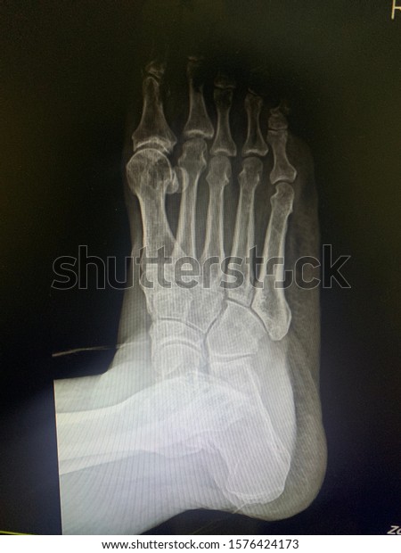 Diffuse Osteopenia No Fracture Dislocation Film Stock Photo 1576424173 ...