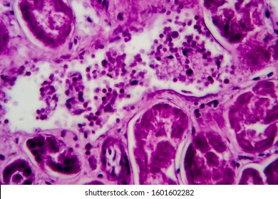 Diffuse Proliferative Glomerulonephritis Dpgn Light Micrograph Stock ...