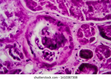 Diffuse Proliferative Glomerulonephritis Dpgn Light Micrograph Stock ...