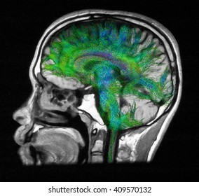 Diffusion Mri Referred Diffusion Tensor Imaging Stock Photo 409570132 ...