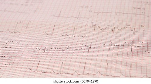 Ecg Results Supra Ventricular Tachycardia Stock Photo (Edit Now) 1555070858