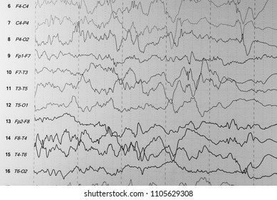 Eeg Patients Problems Electrical Activity Brainabnormal Stock Photo ...