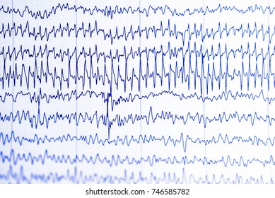 Abnormal Eeg Wave Formabnormal Eegbrain Wave 스톡 사진 1056833492 ...
