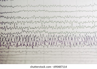 Abnormal Eegbrain Wave On Electroencephalogram Eeg Stock Photo (Edit ...