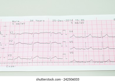 Electrocardiogram Graph Report Stock Photo 242506033 | Shutterstock