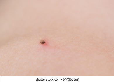 63 imágenes de Tick embedded skin - Imágenes, fotos y vectores de stock ...