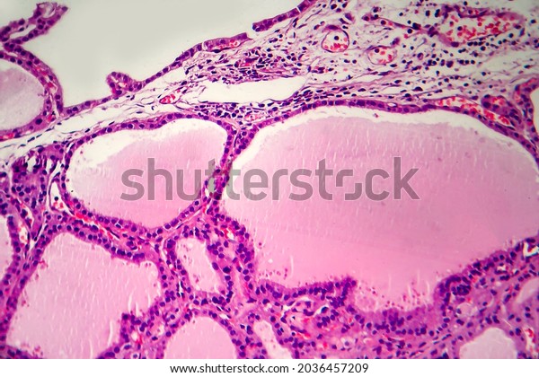 Endemic Goiter Light Micrograph Abnormal Enlargement Stock Photo ...