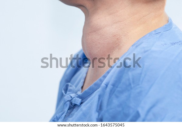 Enlarged Multinodular Thyroid Goiter Middleaged Asian库存照片1643575045 ...