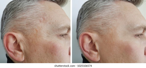 Face Men Before After Procedures Stock Photo 1025106574 | Shutterstock
