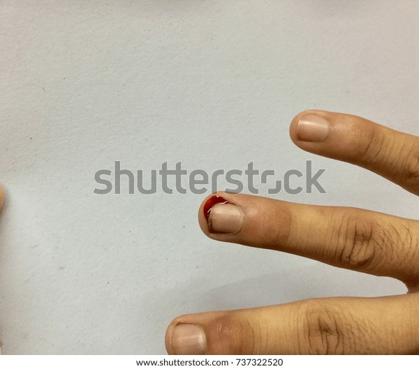 Finger Bleeding Stock Photo 737322520 | Shutterstock