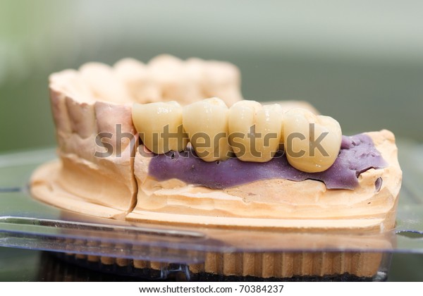 Fixed Partial Denture Dental Bridge On Foto stock 70384237 | Shutterstock