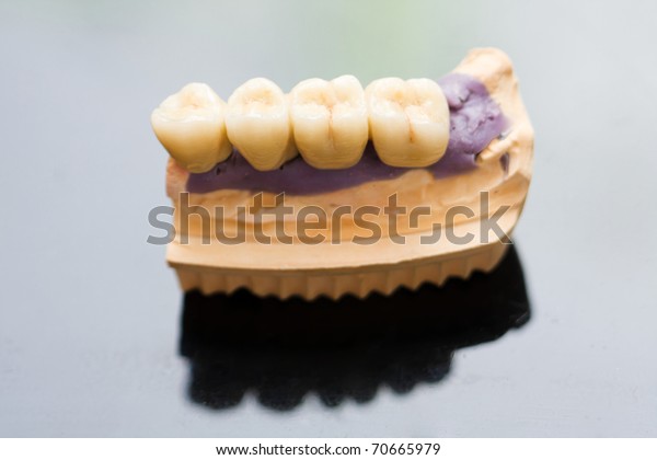 Fixed Partial Denture Dental Bridge On Stock Photo (Edit Now) 70665979