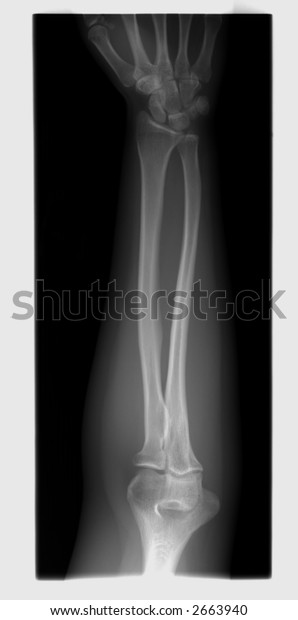 Forearm Xray Stock Photo (Edit Now) 2663940