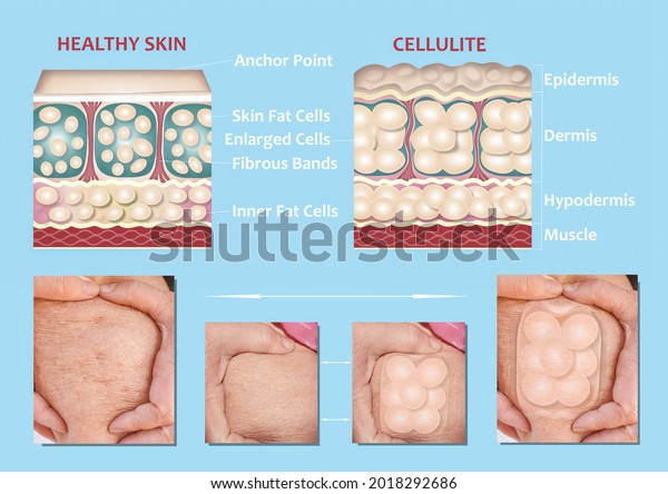 Forming Underskin Cellulite Illustration Structure Normal Stock Photo ...