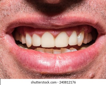 Four Upper Front Teeth After Crown Stock Photo 240812176 | Shutterstock