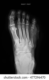 165 Big toe xray Images, Stock Photos & Vectors | Shutterstock