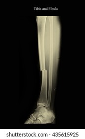Xray Image Show Osteomyelitis Left Tibia Stock Photo (Edit Now) 679237585