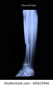 Xray Film Tibia Bone Stock Photo 1522360229 | Shutterstock