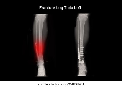 Fracture Leg Tibia Left Stock Photo 404808901 | Shutterstock