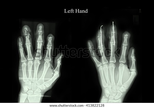 Fracture Middle Finger Ring Finger Left Stock Photo 413822128 ...