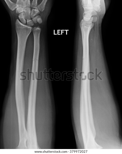 fracture shaft of radius & ulnar bone, x-ray film