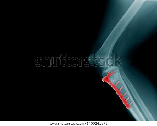 Fracture Tibia Bone Fixed By Plate Stock Photo 1400241593 | Shutterstock