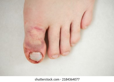 Fractured Toe Broken Big Toe Stock Photo 2184364077 | Shutterstock