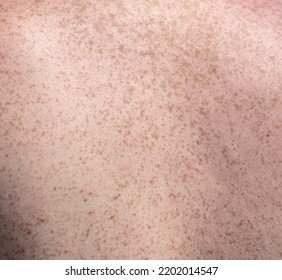 Freckle On Back Man Background Stock Photo 2202014547 | Shutterstock