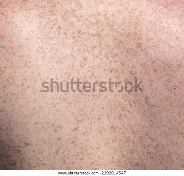 Freckle On Back Man Background Stock Photo 2202014547 | Shutterstock