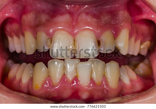 Front View Human Decaying Teeth Bad Stock Photo (Edit Now) 776621503