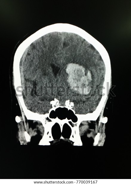 Frontal View Coronal Cut Ct Scan Stock Photo (Edit Now) 770039167