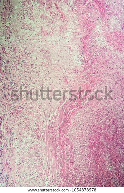 Gall Bladder Necrosis Under Microscope Stock Photo 1054878578 ...