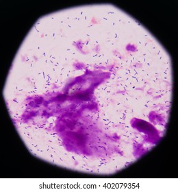 Cytochemical Staining Laboratory Haematologymyeloperoxidase Positive ...