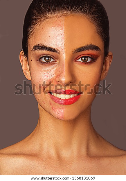Half Face Acne Skin Problem Half Stock Photo 1368131069 | Shutterstock