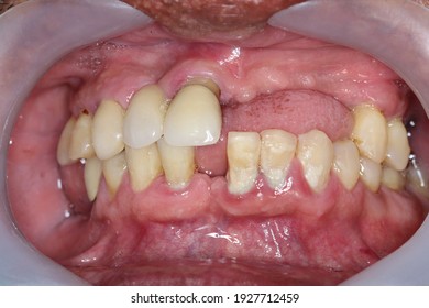 48 Edentulous arch Images, Stock Photos & Vectors | Shutterstock