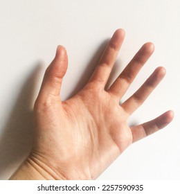 Realistic-photograph-of-a-red-swollen-hand-thats-been-injured-by ...