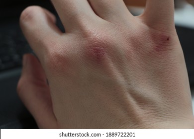 Hand Cracked By Cold Problem Sensitive Stock Photo 1889722201 ...
