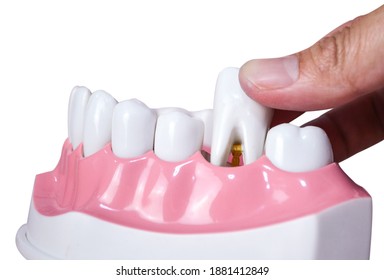 Hand Extracting Molar Tooth Hand Pulling Stock Photo (Edit Now) 1879094947