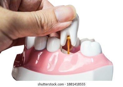 Hand Extracting Molar Tooth Hand Pulling Stock Photo (Edit Now) 1879094947